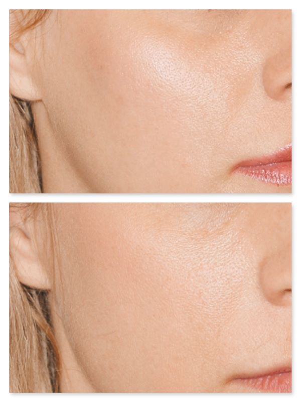 Cheek Fillers - Dr MediSpa Essex & London | Dr MediSpa Essex & London