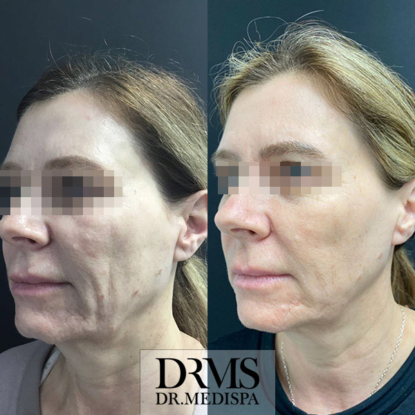 Morpheus8 Skin Tightening at Dr Medispa in London & Loughton Essex