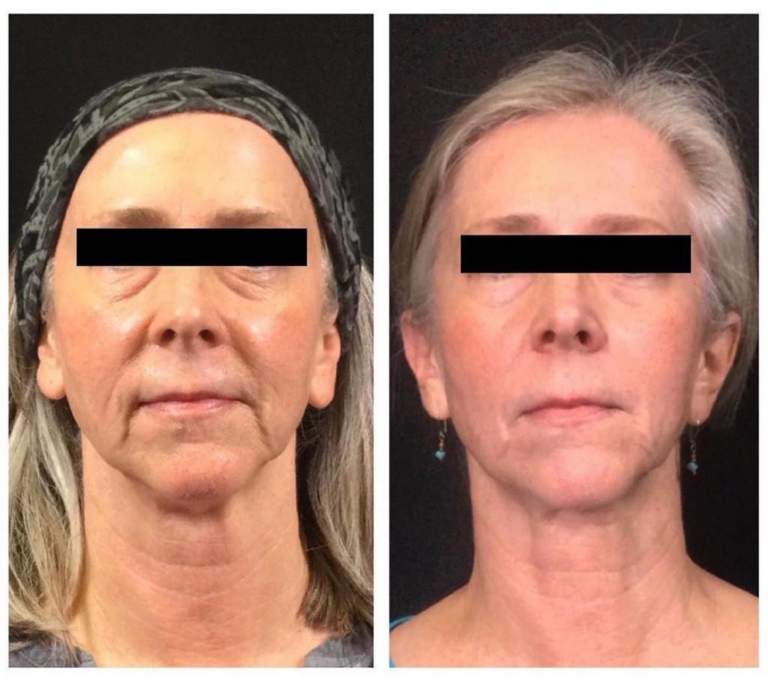 SOFWAVE™ – Collagen Regeneration - Dr MediSpa Award Winning Clinics